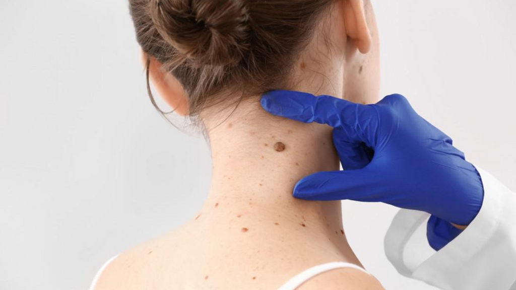 What to look out for: harmless mole or potential skin cancer? – Solbari ...