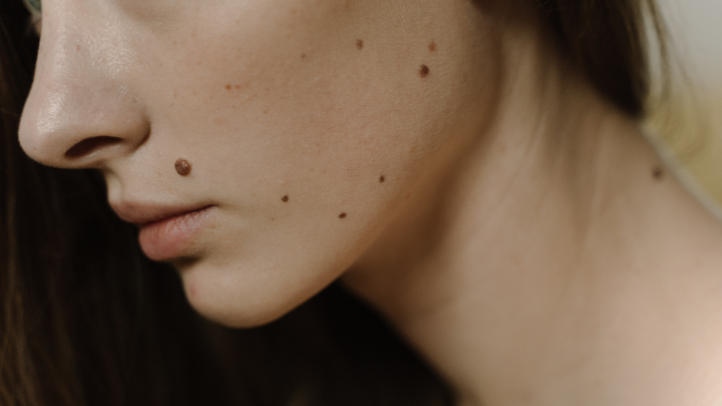 How do I know if a mole is cancerous? | Skin Health Blog | Solbari ...